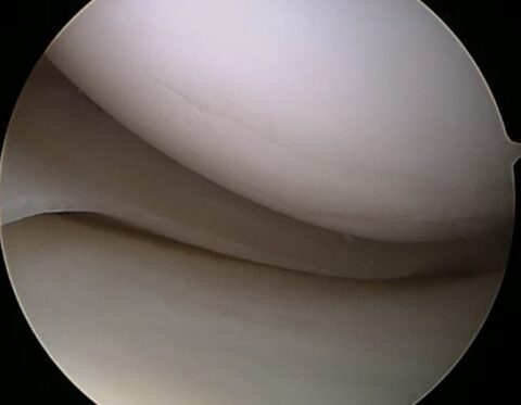 Knee Arthroscopy for Meniscus Tears: What You Need to Know